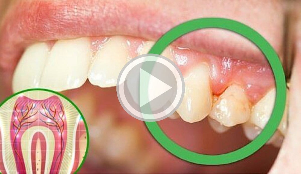 Reverse Cavities — Tooth Decay Healed By This Odd Pantry-Mixture ...