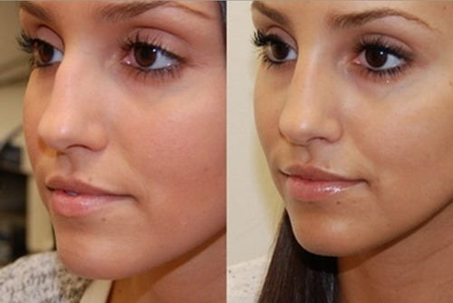 Some Simple Procedures of Nose Reshaping Without Surgery | by Ridaul ...