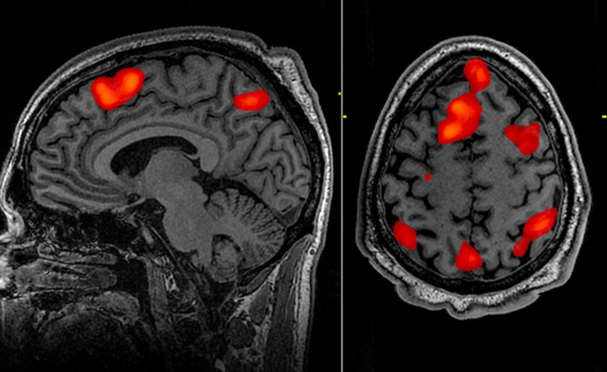 Extending the Understanding of Schizophrenia with AI | by Margo Le ...