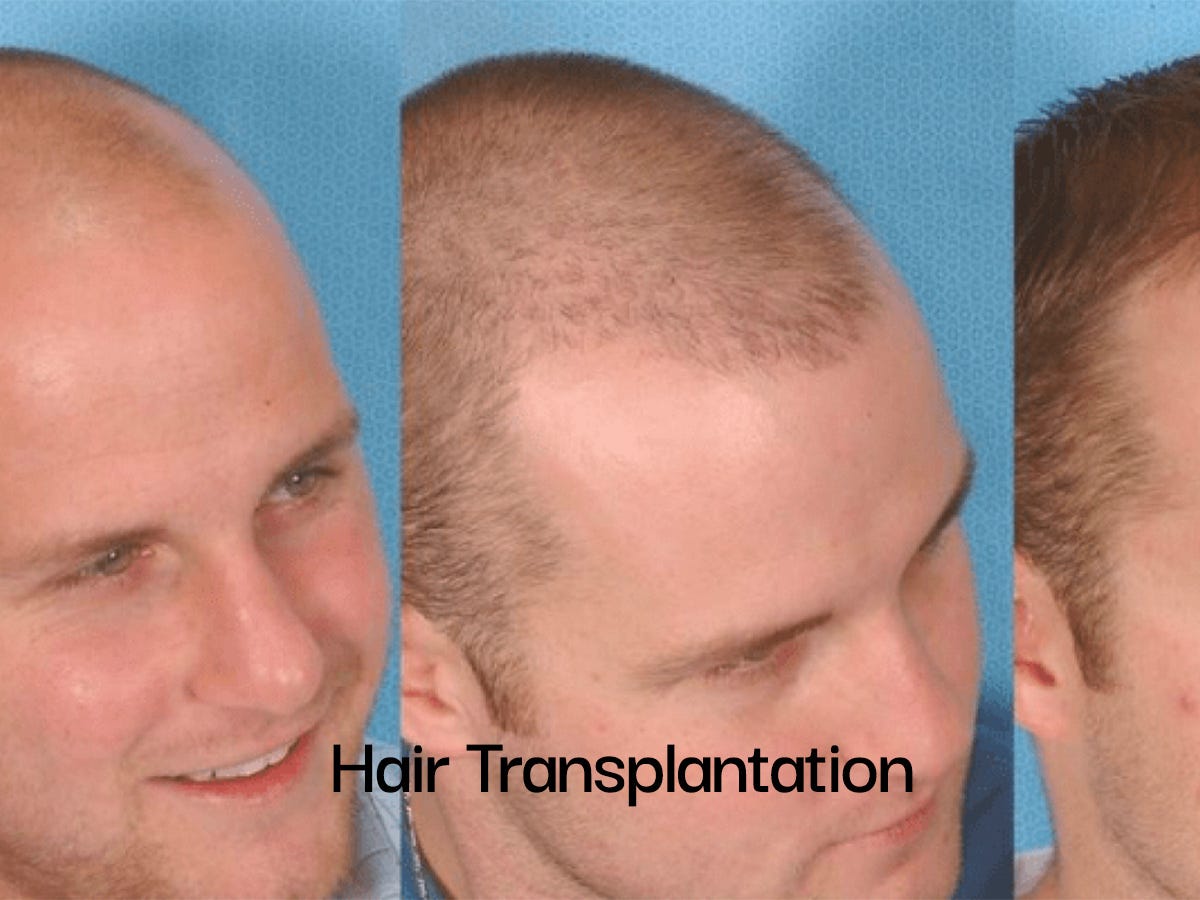 What is Hair Transplantation? How is it done? | by Emilia Blaese | Medium