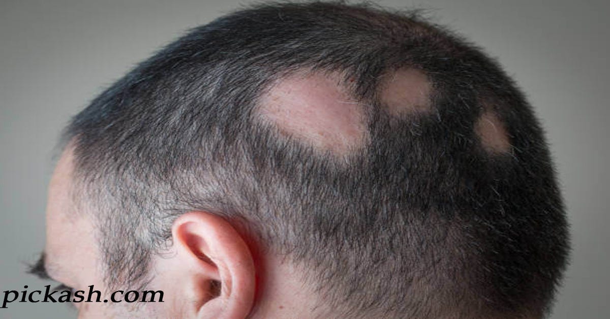 Alopecia Areata: Causes, Symptoms, and Diagnosis | by Pick Ash | Medium