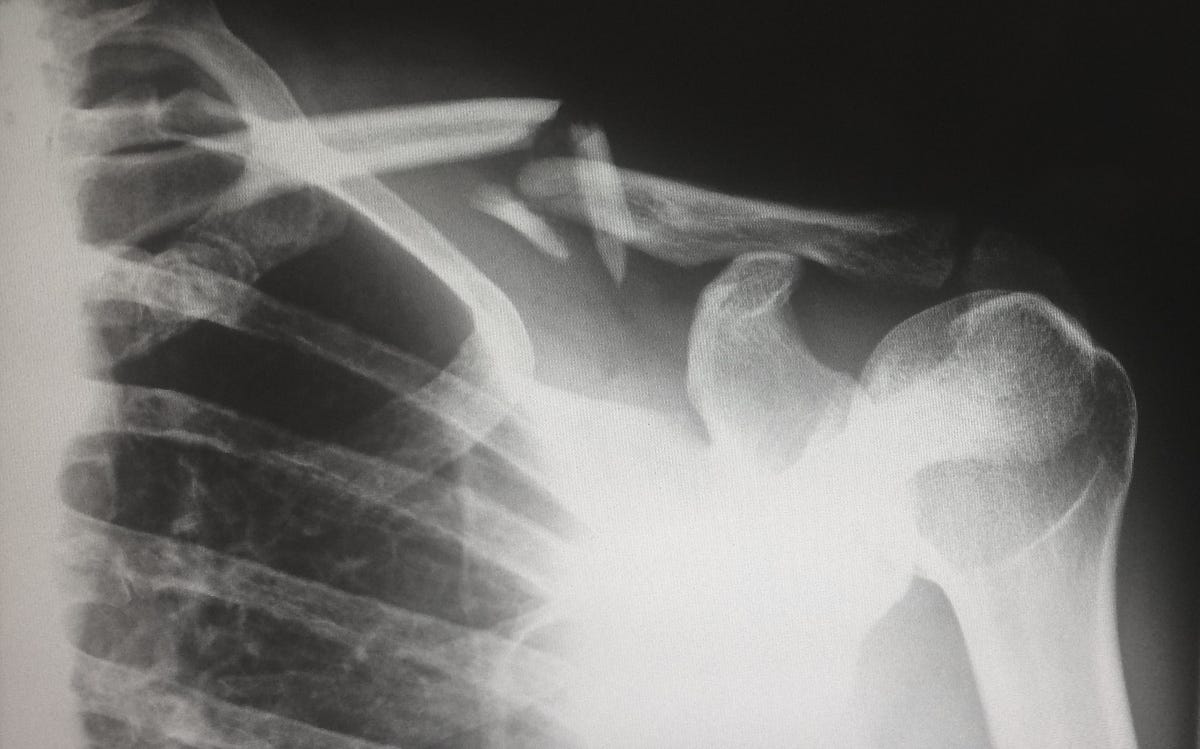 Do Broken Bones Grow Back Stronger Than Before By Cindy Heath