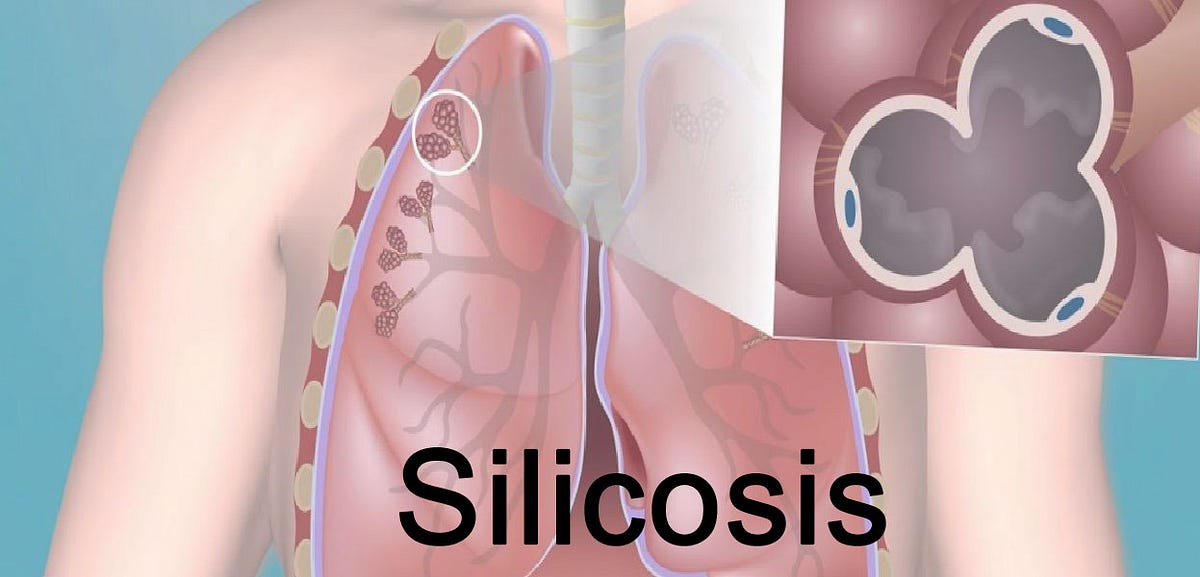 Silicosis
