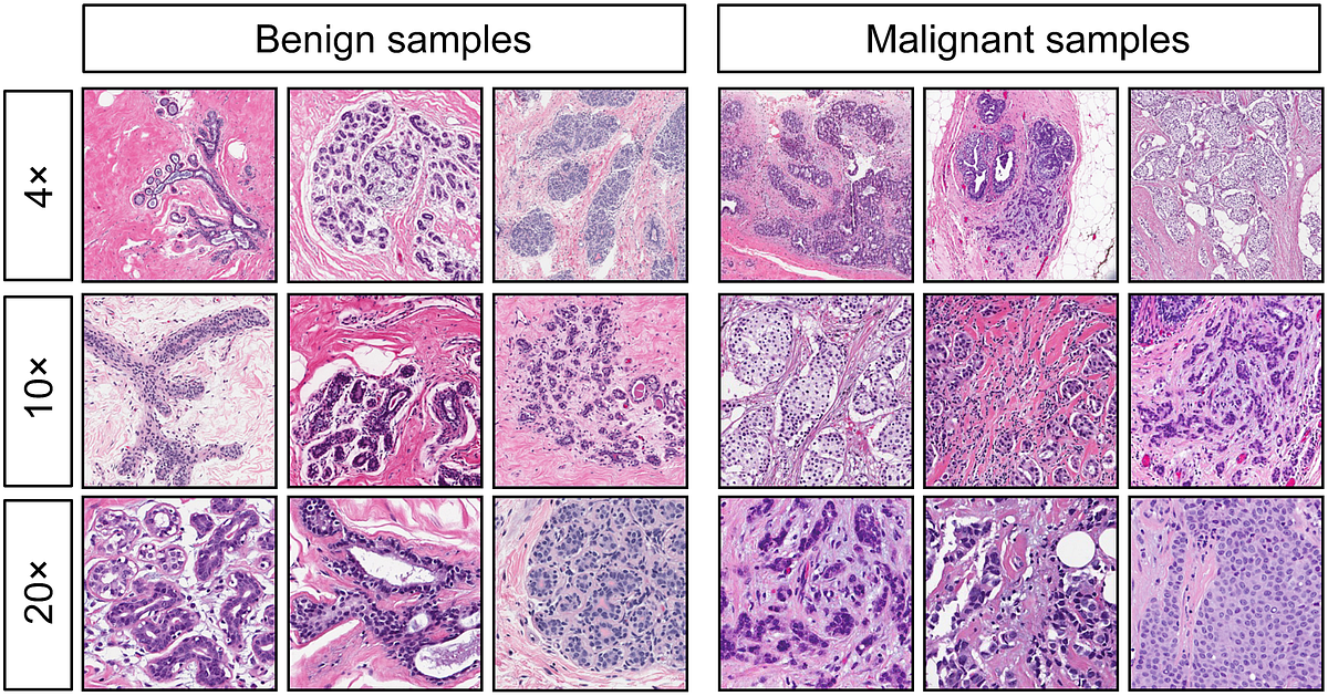 Classifying Malignant and Benign Breast Cancer Tumours with a Neural ...