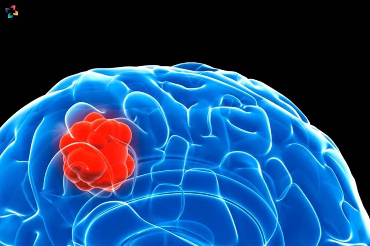 Decoding Glioblastoma Multiforme: Understanding the Most Aggressive ...