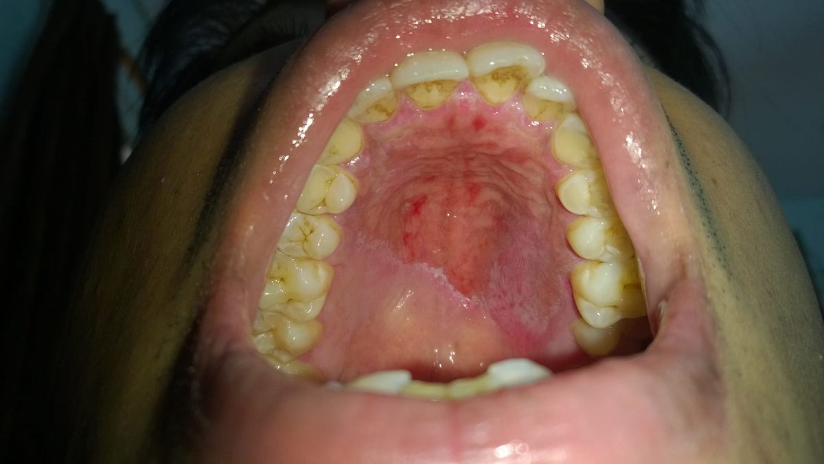 Why Is The Roof Of My Mouth Sore 2024 | by Guoqiangkuaile | Medium