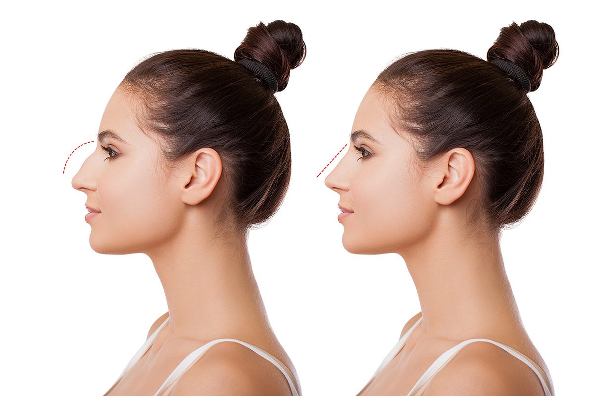 The Latest Rhinoplasty Techniques Available in Riyadh | by Muhammad ...