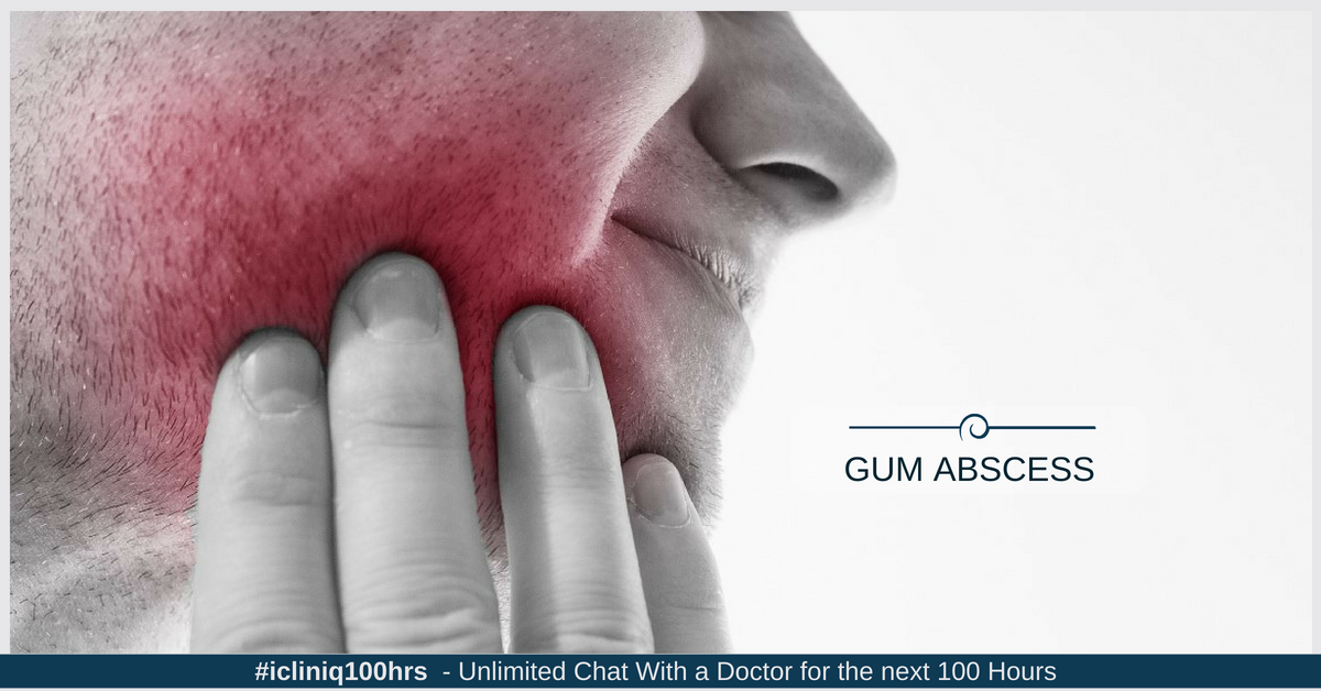 Pericoronal Abscess