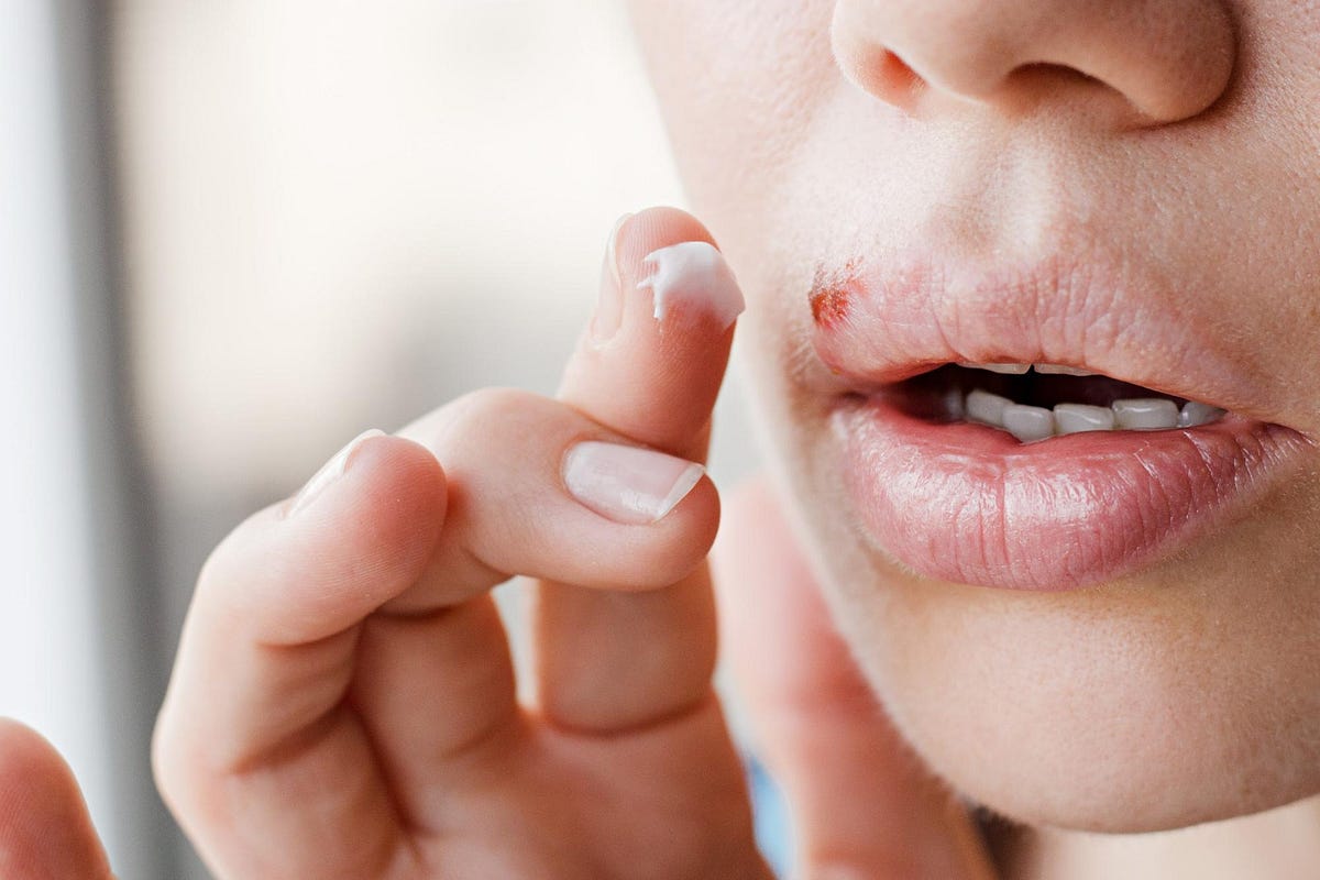 How to treat a cold sore. Do you or someone you know have cold… | by ...