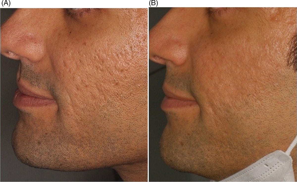 Affordable Scar Treatment in Delhi | by Sanjana | Aug, 2024 | Medium
