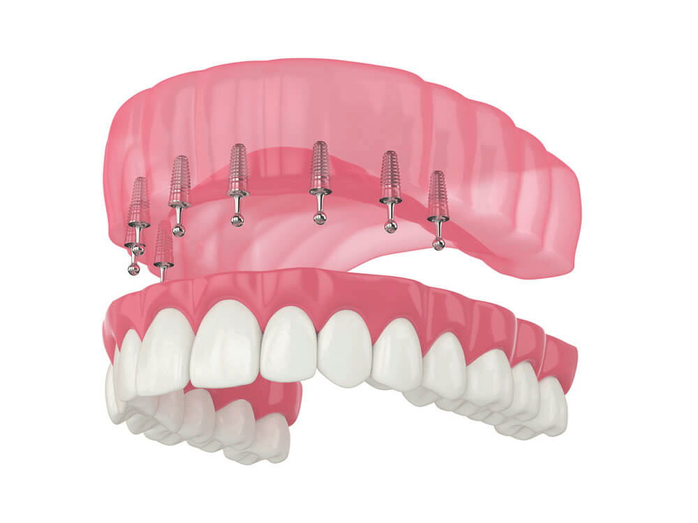 Everything You Need to Know About Snap-On Dentures | by Archpoint ...