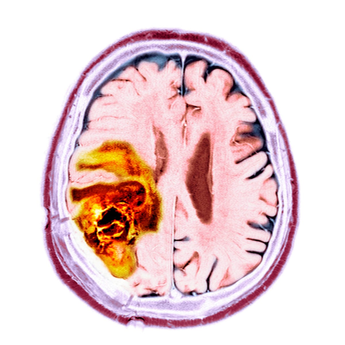 Cancer’s Influence on the Brain: When Tumors Take Over More Than Just ...