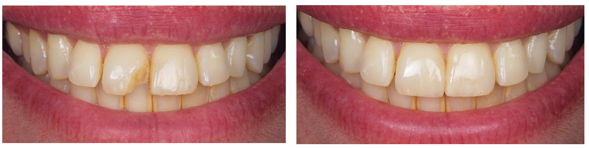An Effective Ceramic Polishing Technique | by Mr Bur | Medium