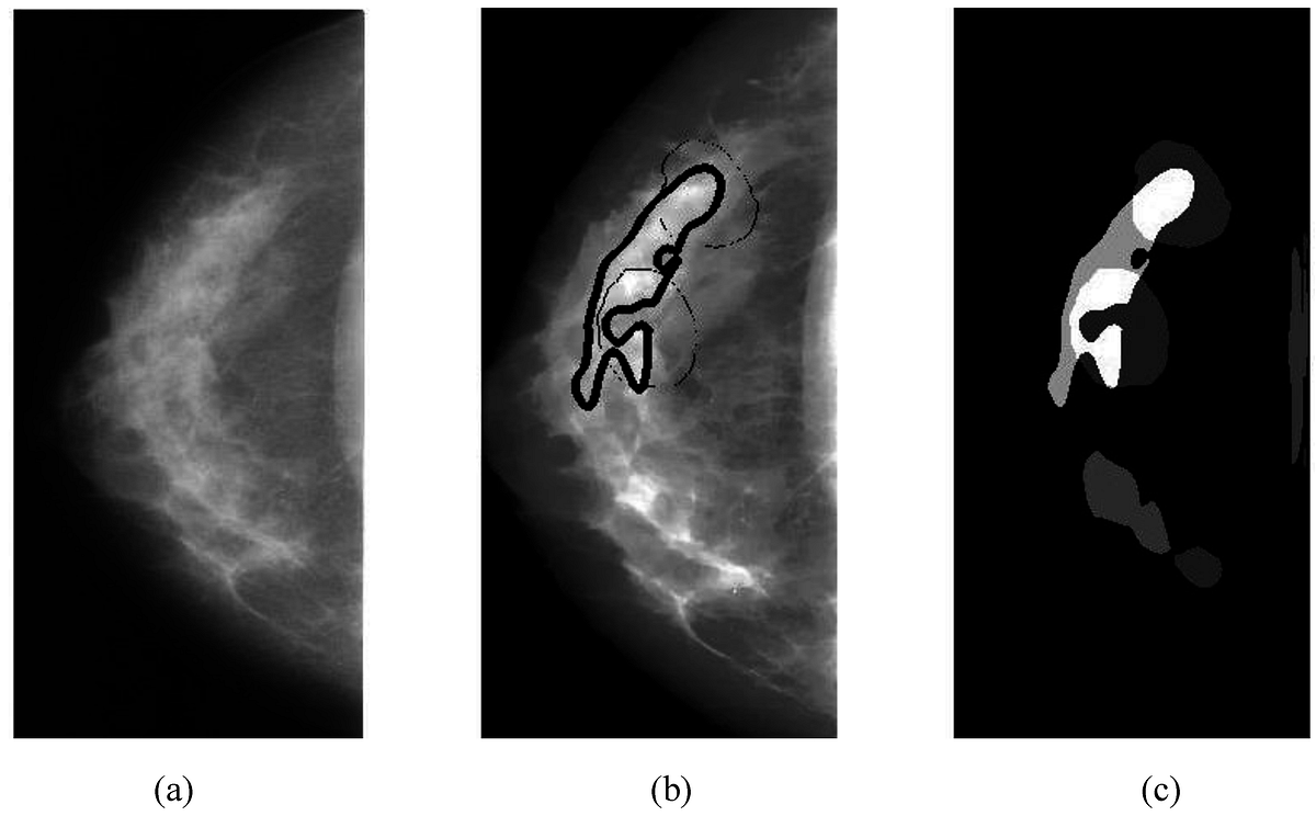 Breast Cancer Detection with KNN Algorithm | by Hela Ben Amor | Medium