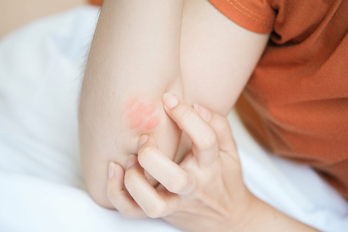 Home Remedies for Ringworm that Actually Work! | by Home Remedy ...