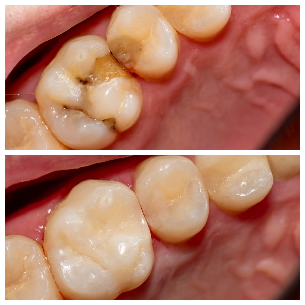 Dental Fillings: What You Should Know | by Richard Dawson | Medium