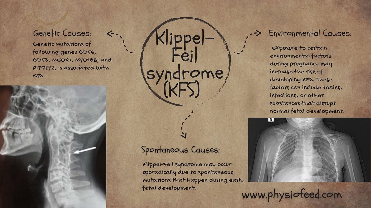 Klippel-Feil syndrome (KFS): Physiotherapy Management | by Rimsha ...