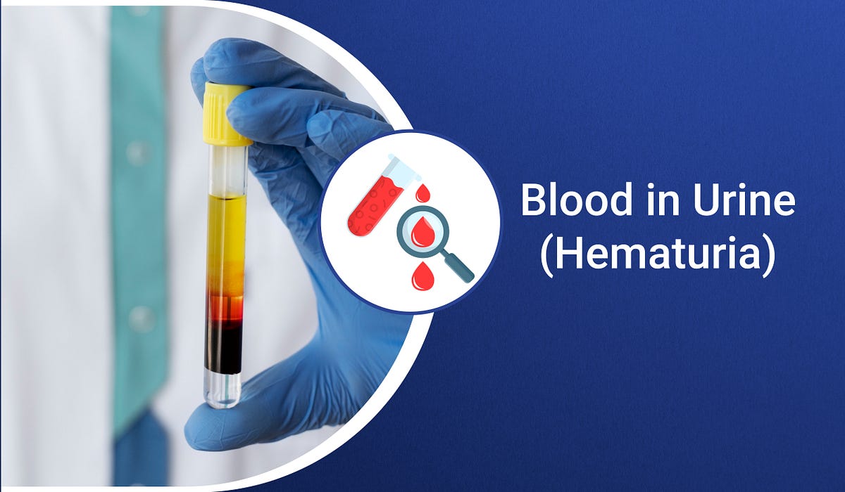 Blood In Urine (Hematuria): Explain By Leading Urologist | by ...