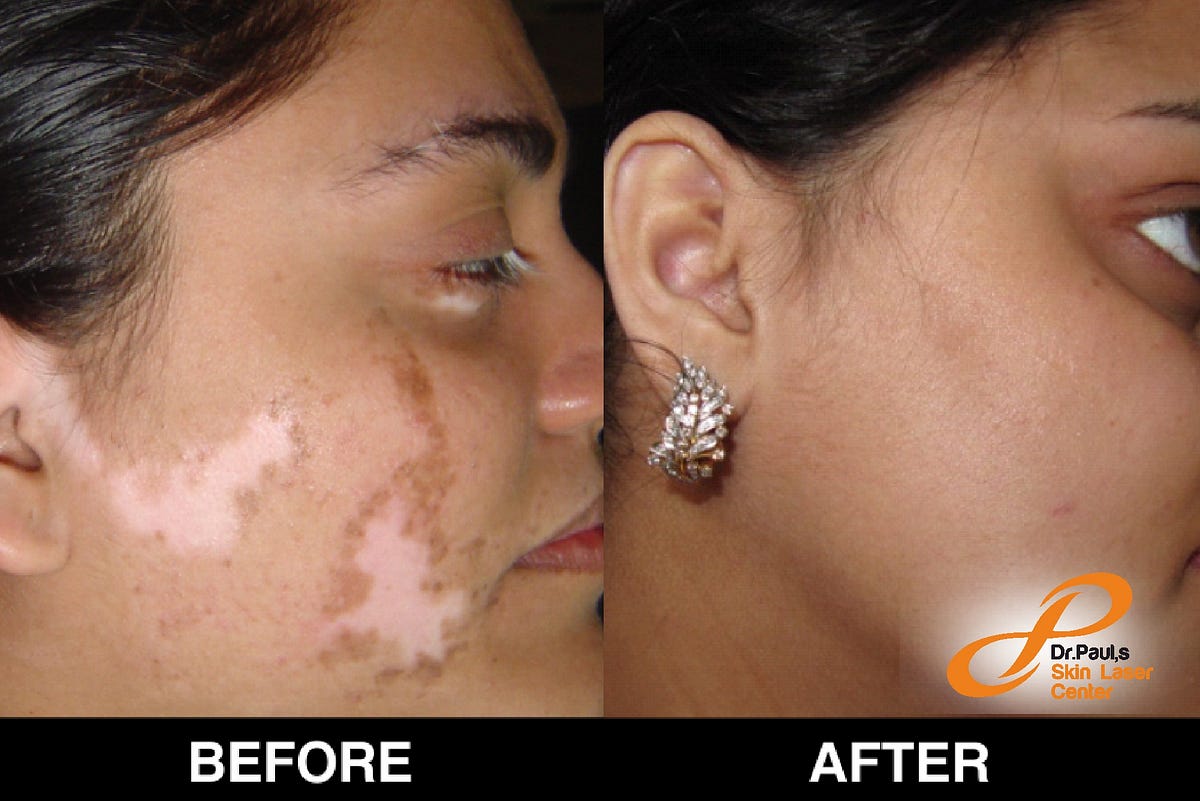 Cause For Vitiligo Or White Patches Seen On The Skin | by Skin Laser ...