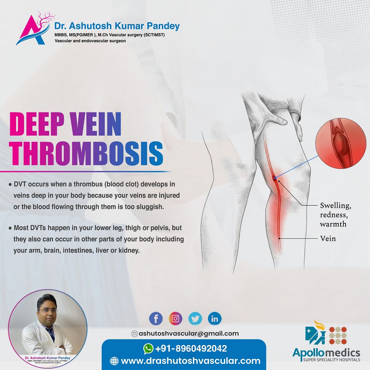 Vascular Surgeon In Lucknow. Deep Vein Thrombosis (DVT) is a serious ...