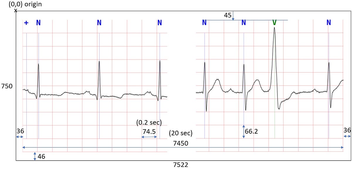 Locate V-beat in Electrocardiogram (ECG) | by Black_Raven (James Ng ...