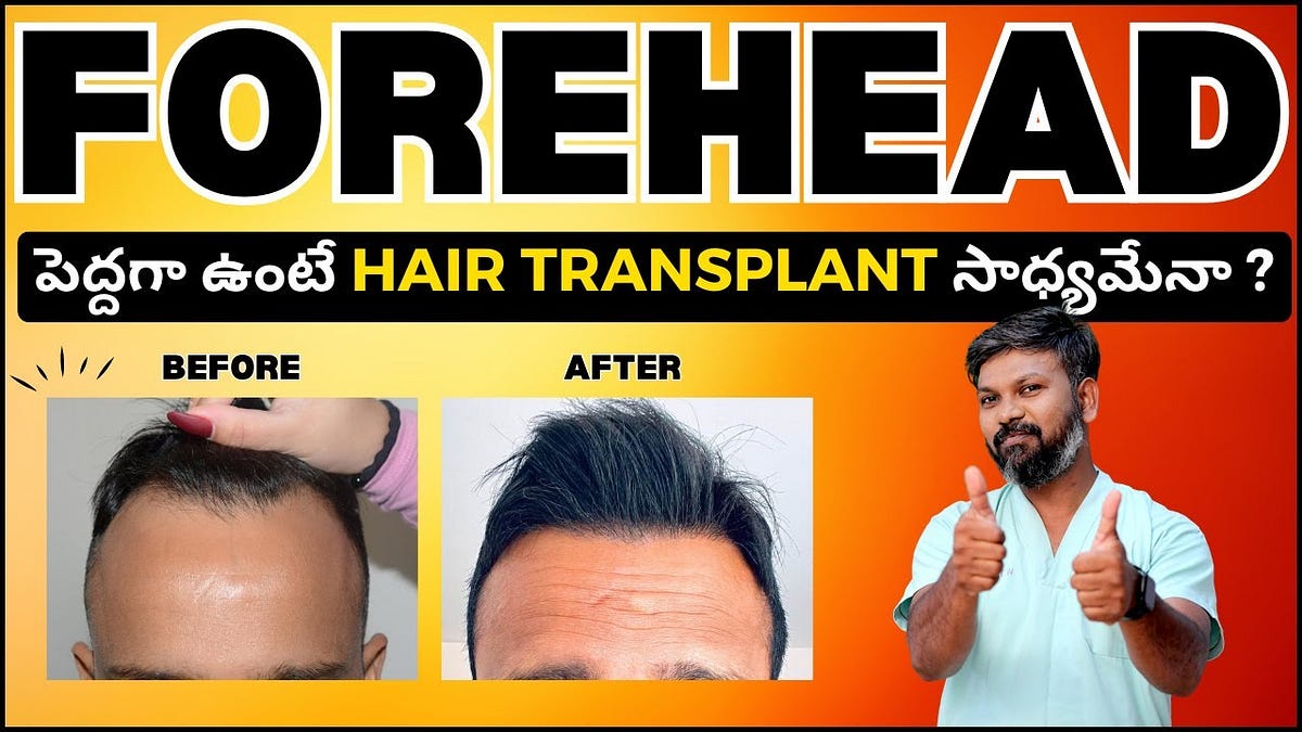 Can one look aged with a broad forehead? Can a hair transplant ...