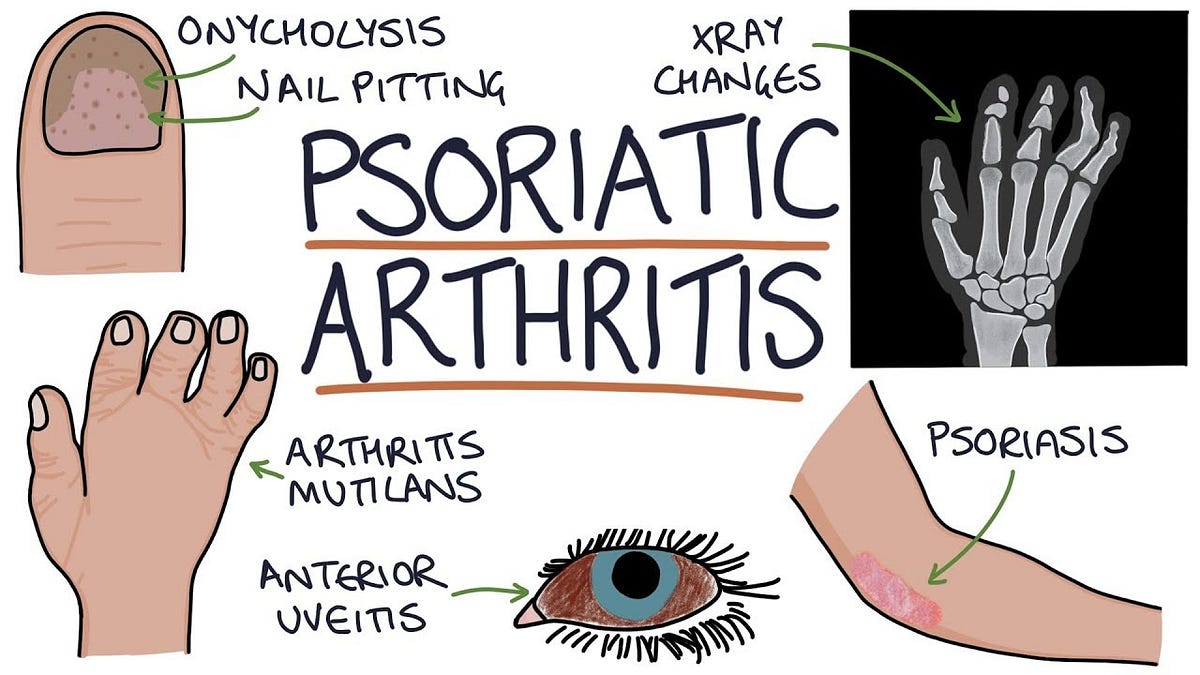 Psoriatic arthritis. Pathophysiology and epidemiology | by Aayush Pokharel | Medium