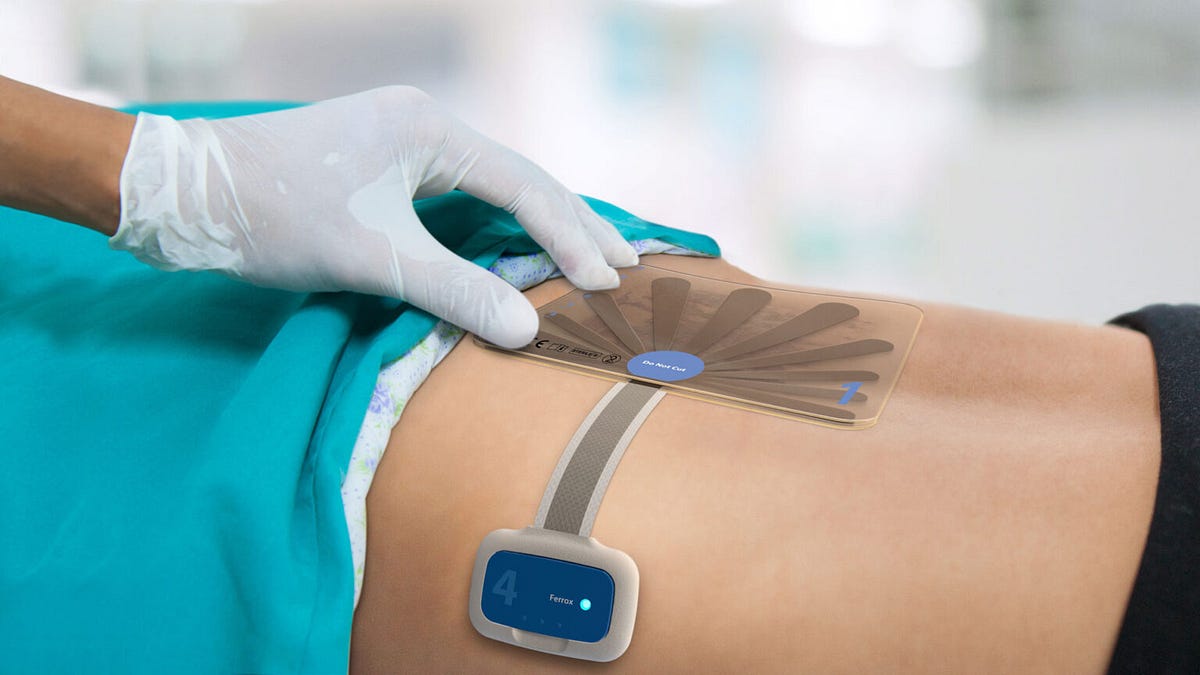 The Role of Sutures, Staples, and Adhesives in Wound Closure: When to ...