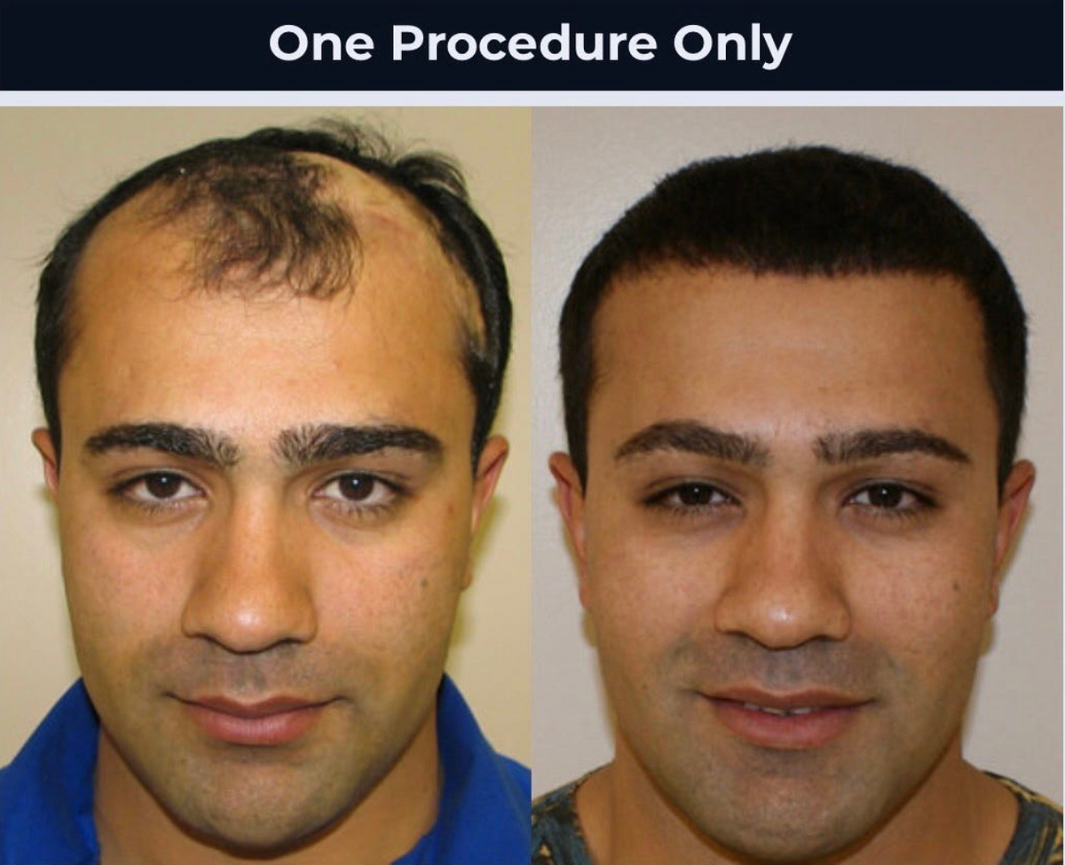 Dr. Brett Bolton Offers Corrective Surgery for Childhood Trauma Hair ...