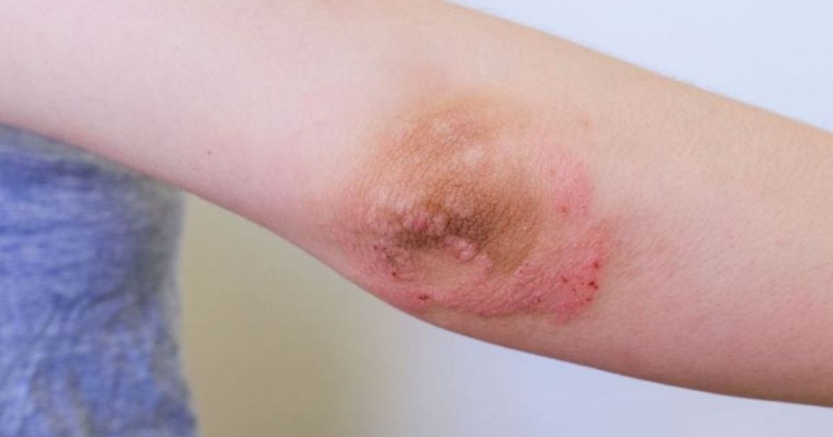 Diabetic patients should adopt these 5 methods in case of injury, it ...