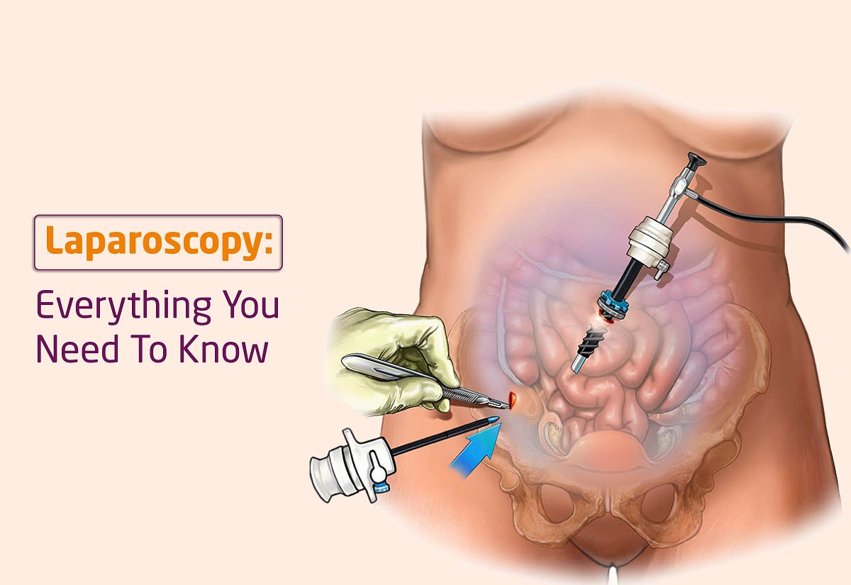 Why India is Best for Laparoscopy Surgery? | by Health Rescue | Medium