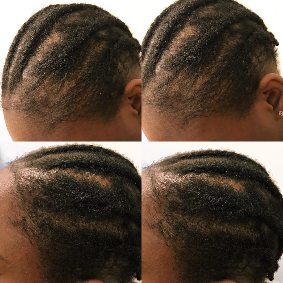 How to combine proTHIK with minoxidil application? | by proTHIK PR girl ...