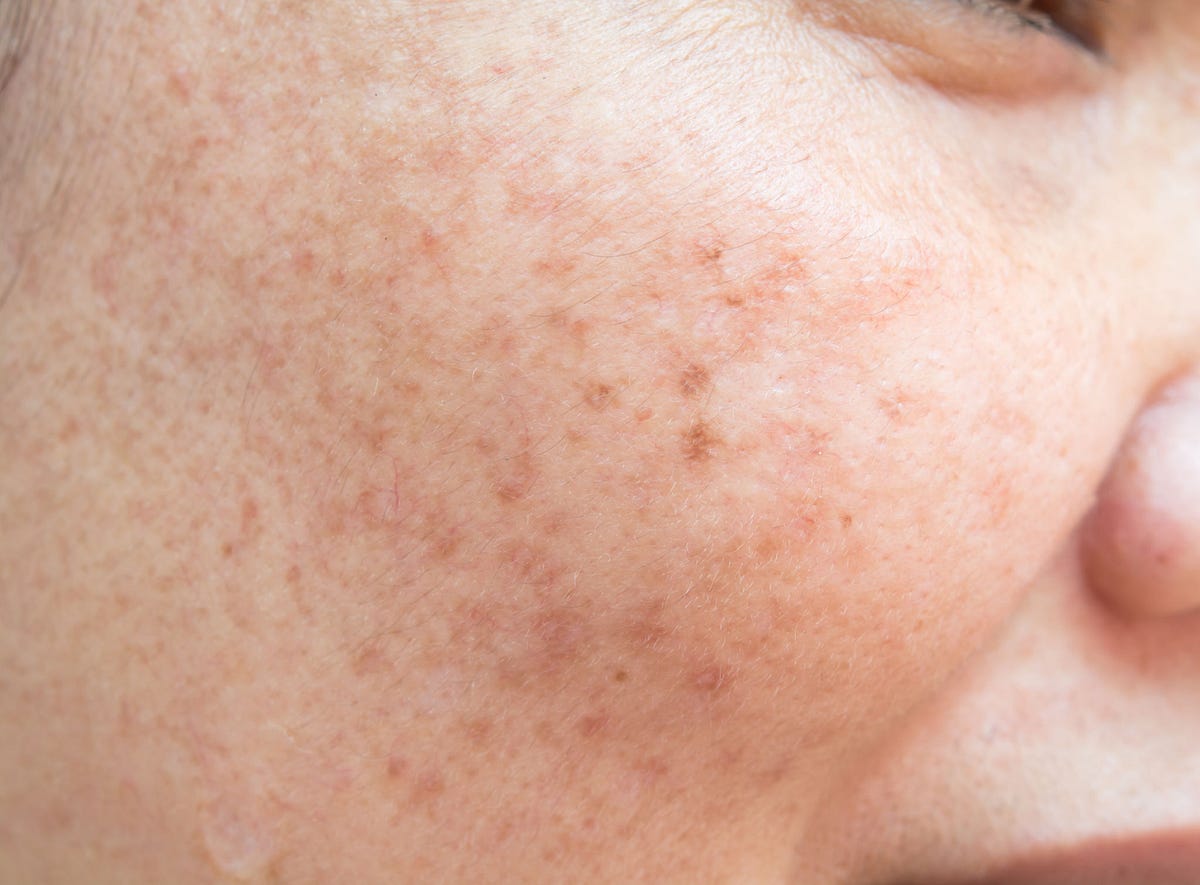 How To Fade Deep-Pitted Acne Scars? | by Influennzclinic | Medium