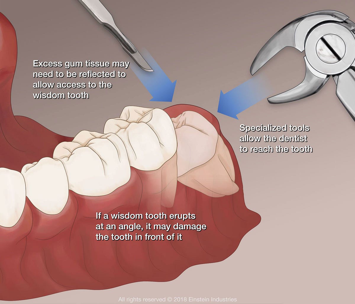 Remedies for Wisdom Teeth Pain - Hill Regional Hospital - Medium