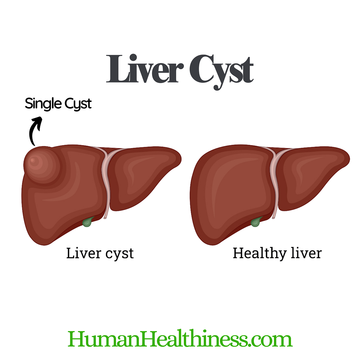 Liver and Kidney Cyst: Symptoms, causes and treatments - Human ...