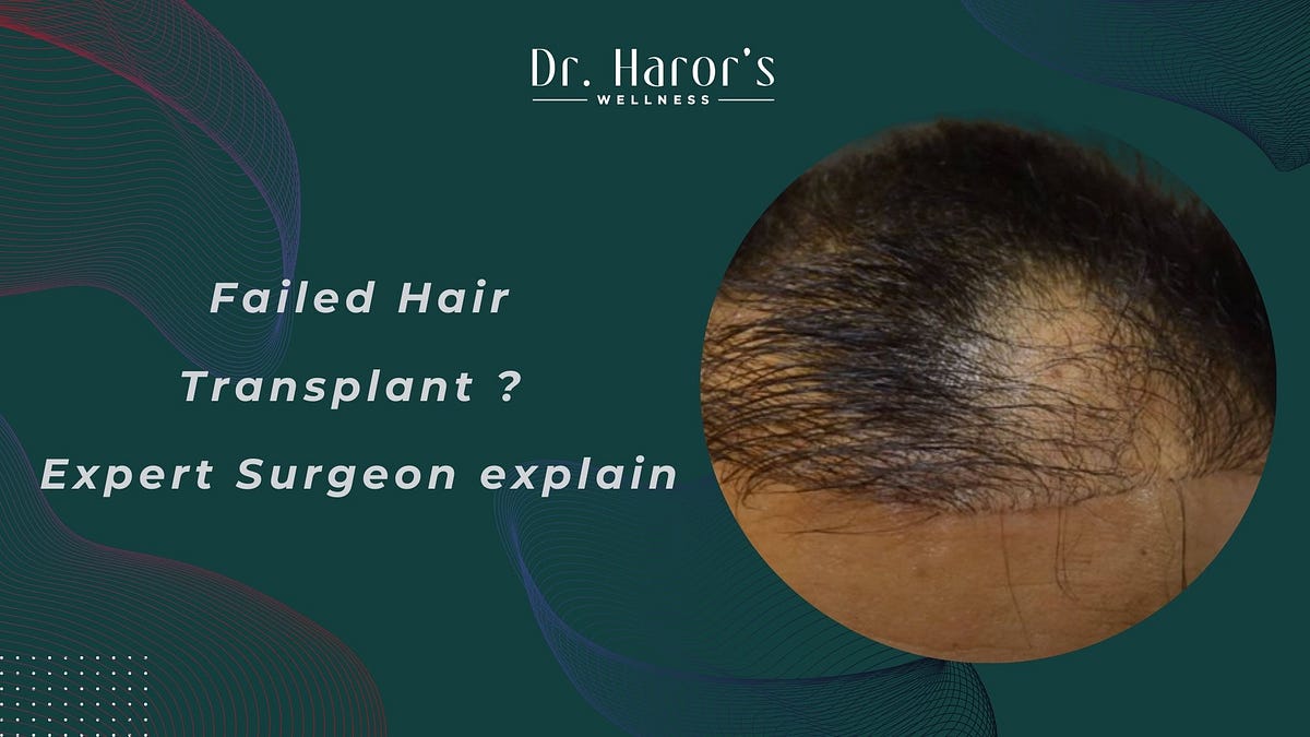 Failed Hair Transplant ? Expert Surgeon explain | by Dr Haror's ...