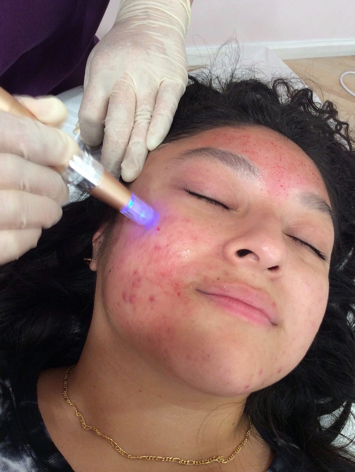 Vampire Facelift in Dubai. In the bustling city of Dubai, where… | by ...