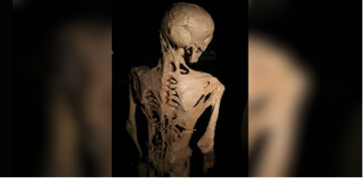 Stone man disease: A rare condition that causes a person to grow a ...