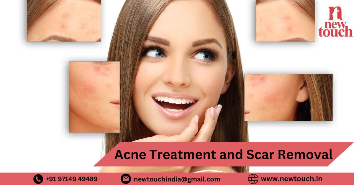 Acne Treatment and Scar Removal: Clearing Your Skin | by NewTouch | Medium