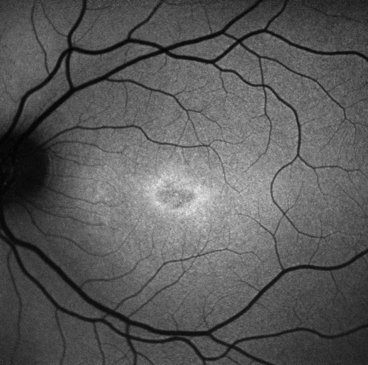 Bull’s Eye Maculopathy. CAUSES: | by Rehman Siddiqui | Medium