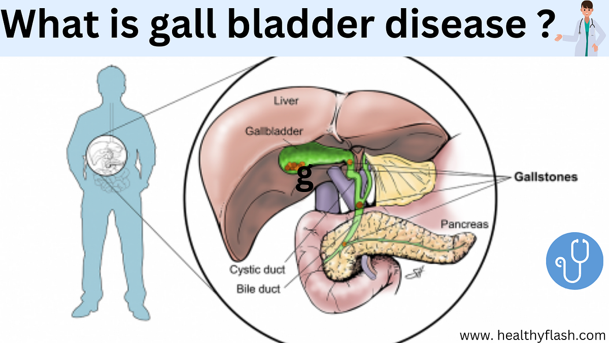 Understanding The Intricacies of The Gall Bladder A Comprehensive Guide ...