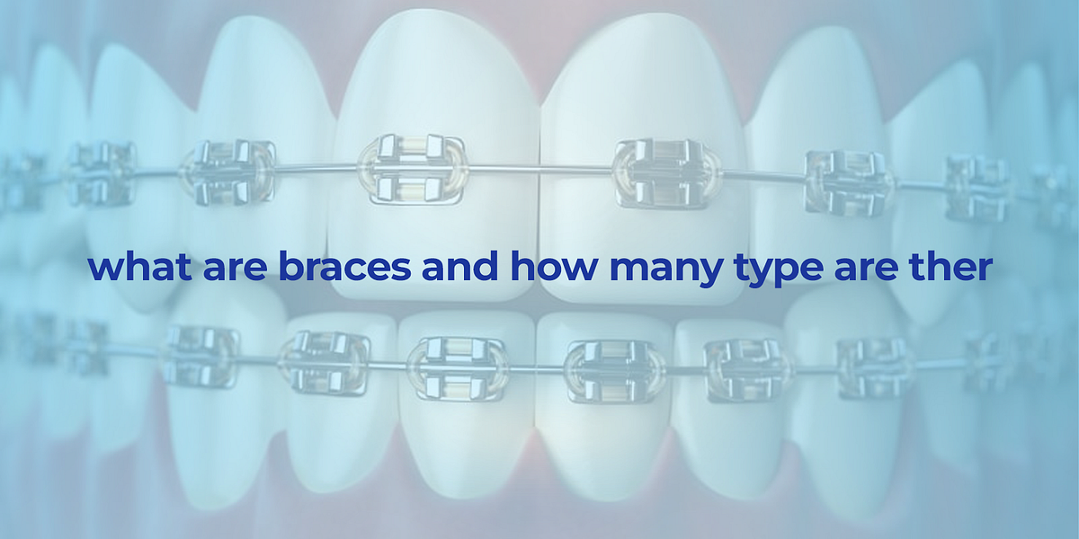 what are braces and how many type there are | by Kayşehir dental clinic ...