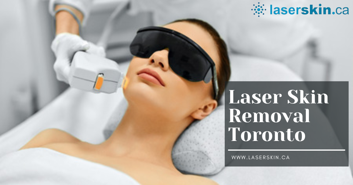 Laser Skin Removal Toronto - Laserskin - Medium