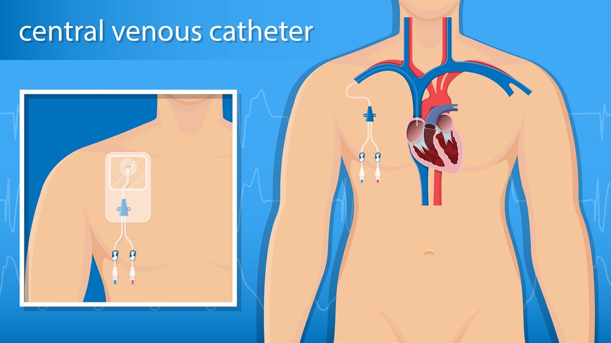 Central Venous Catheters (CVC): Purpose, Types, Procedure, Recovery | by Poonam Cmi | Medium