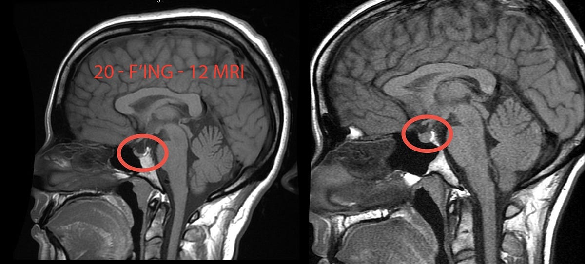 Path to diagnosis (Part I: An empty sella) | by Jennifer Brea | Medium