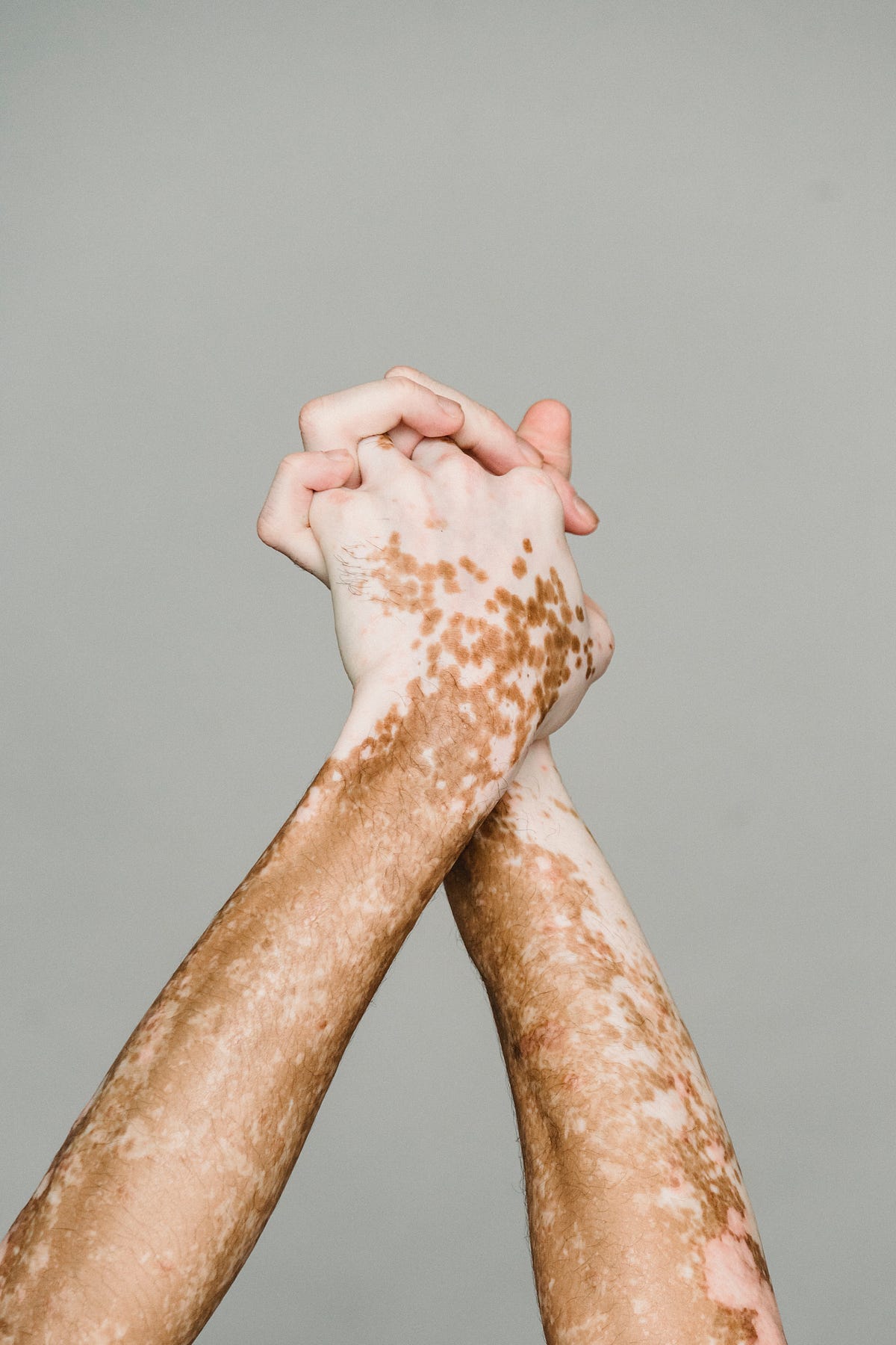 How to Treat Vitiligo Naturally. Vitiligo is actually a skin infection ...
