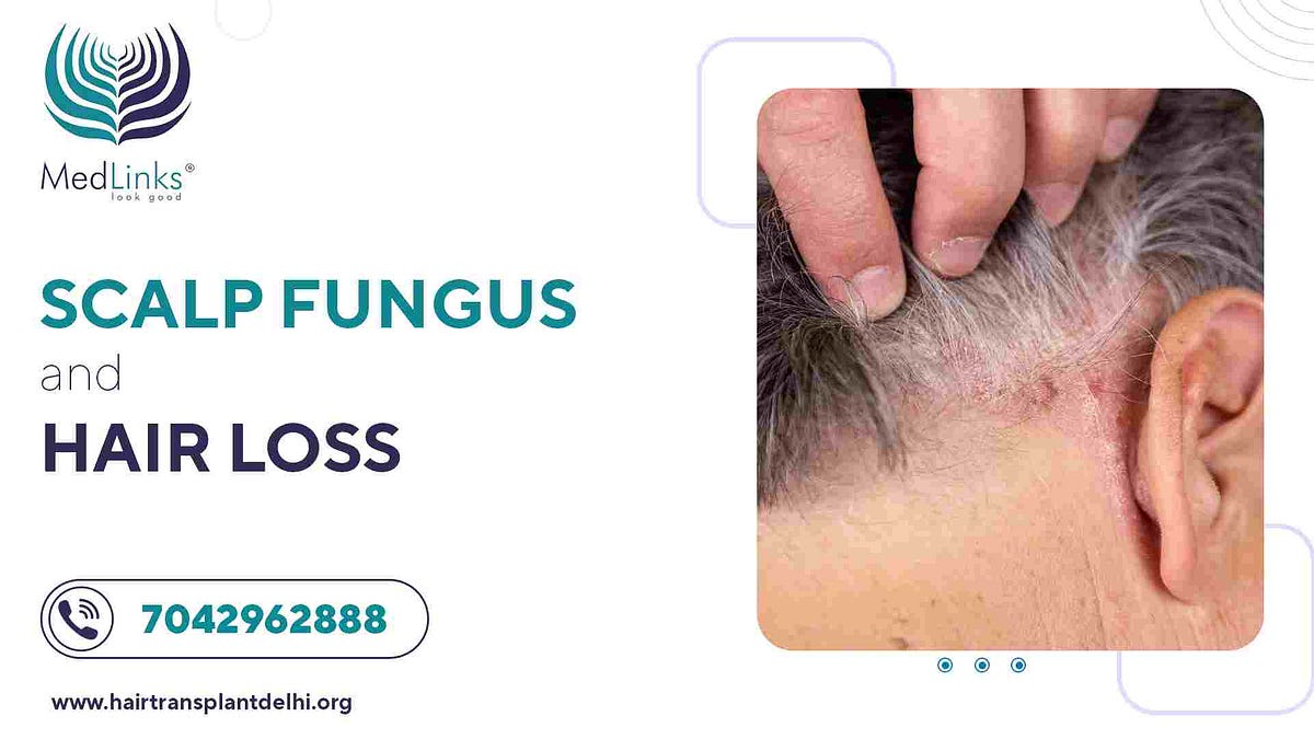 Scalp Fungus and Hair Loss: Understanding the Itch and the Patchy Loss ...