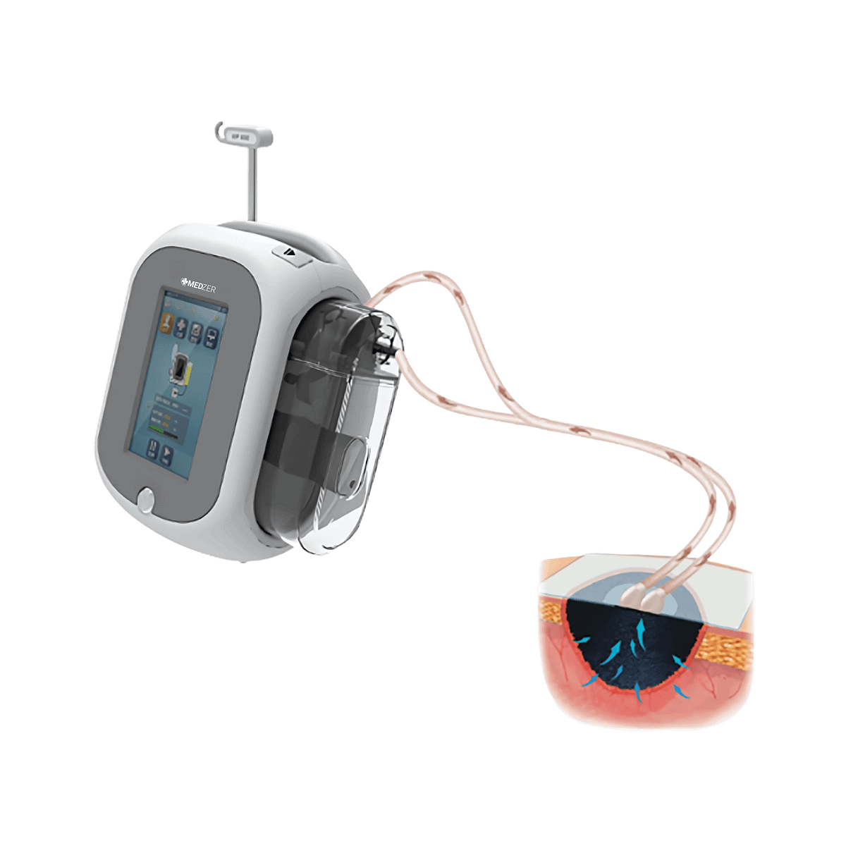 Revolutionizing Wound Care with Negative Pressure Wound Therapy | by ...