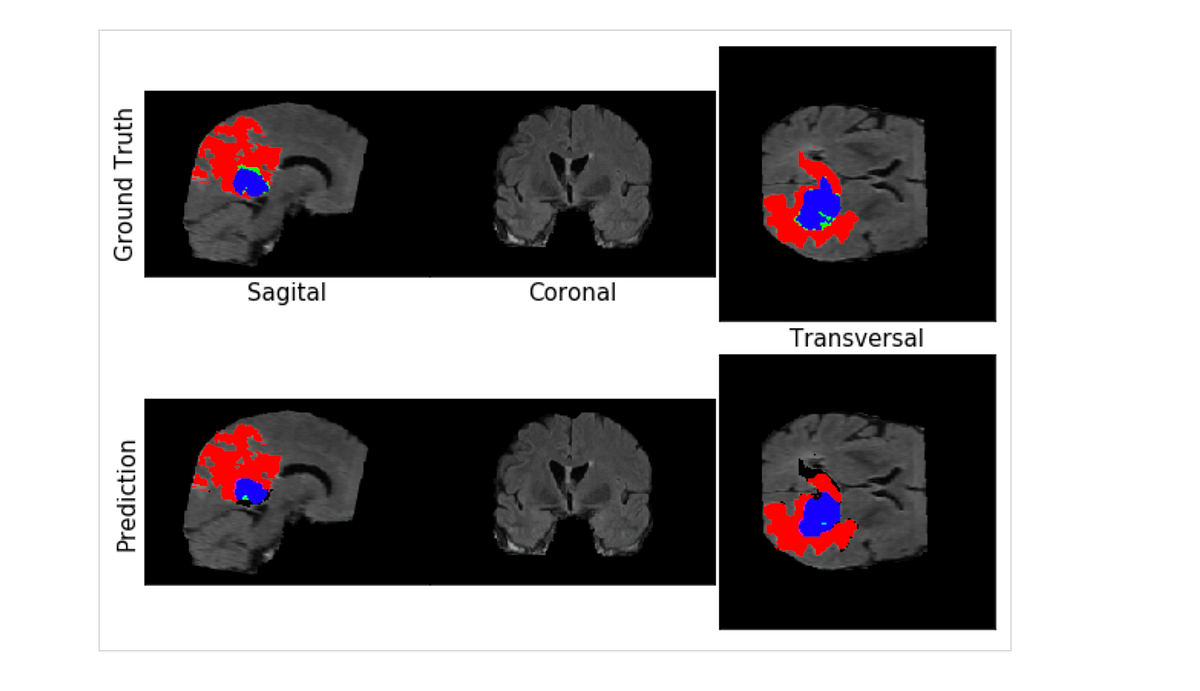 L’IA permet de lutter contre les tumeurs cérébrales grâce à la segmentation des images ...
