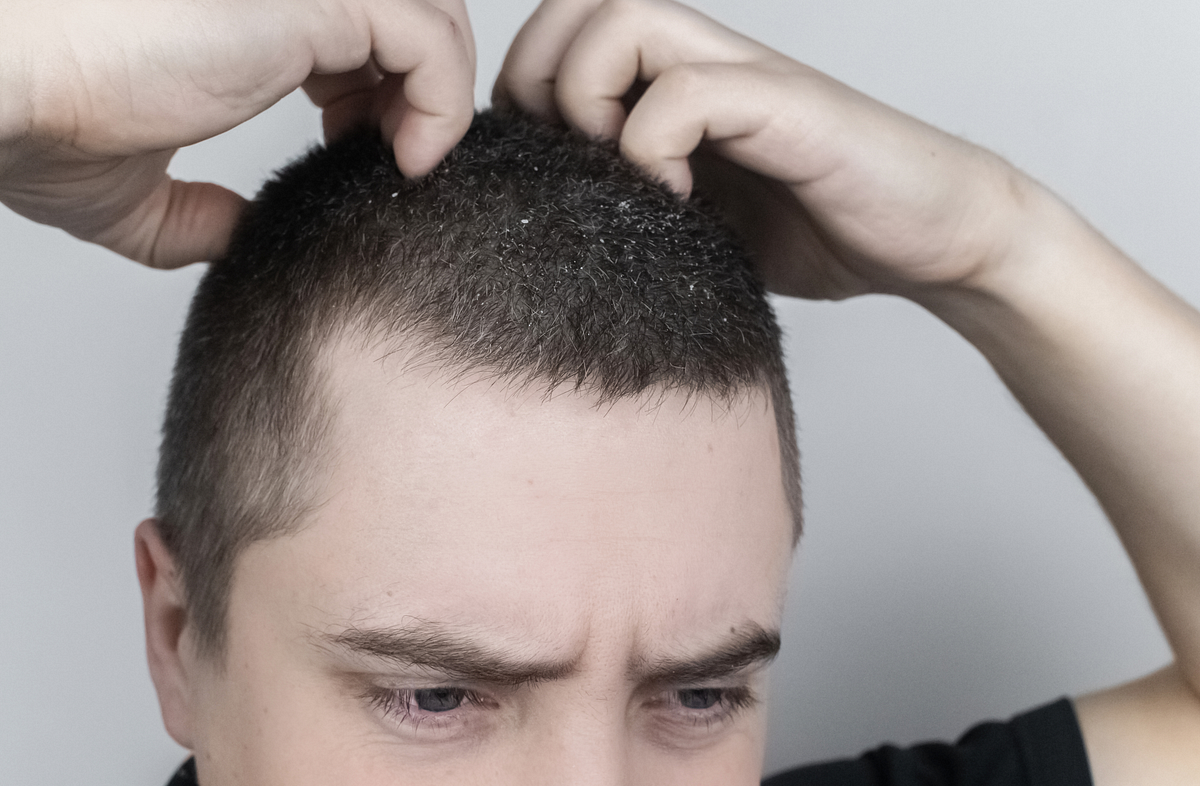 YOUR SCALP ISN’T DRY!. How to easily treat dandruff | by Annie Foley ...